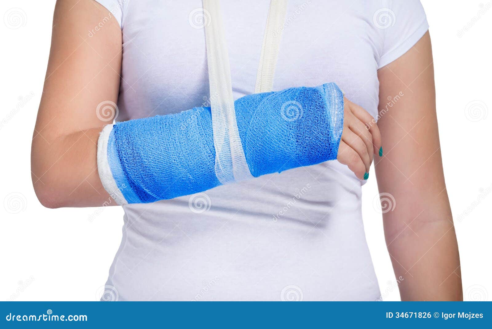 Patient with a cast on arm stock photo. Image of accident - 34671826