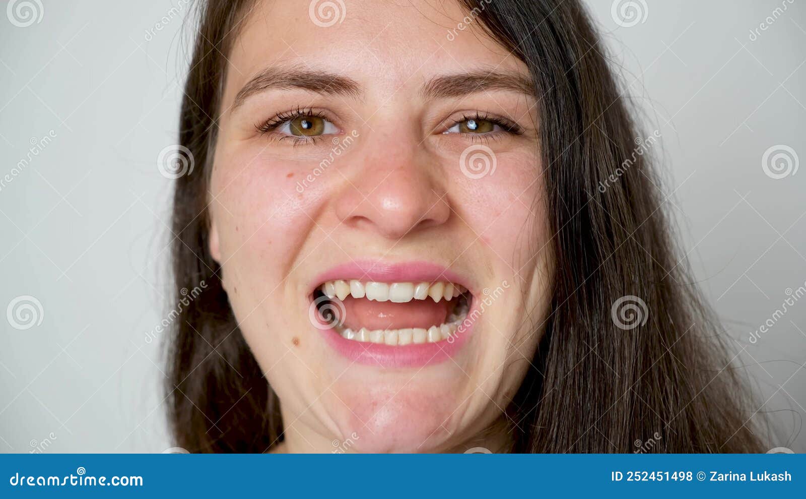 Patient with Dislocated Jaw and Malocclusion, Temporomandibular Joint ...