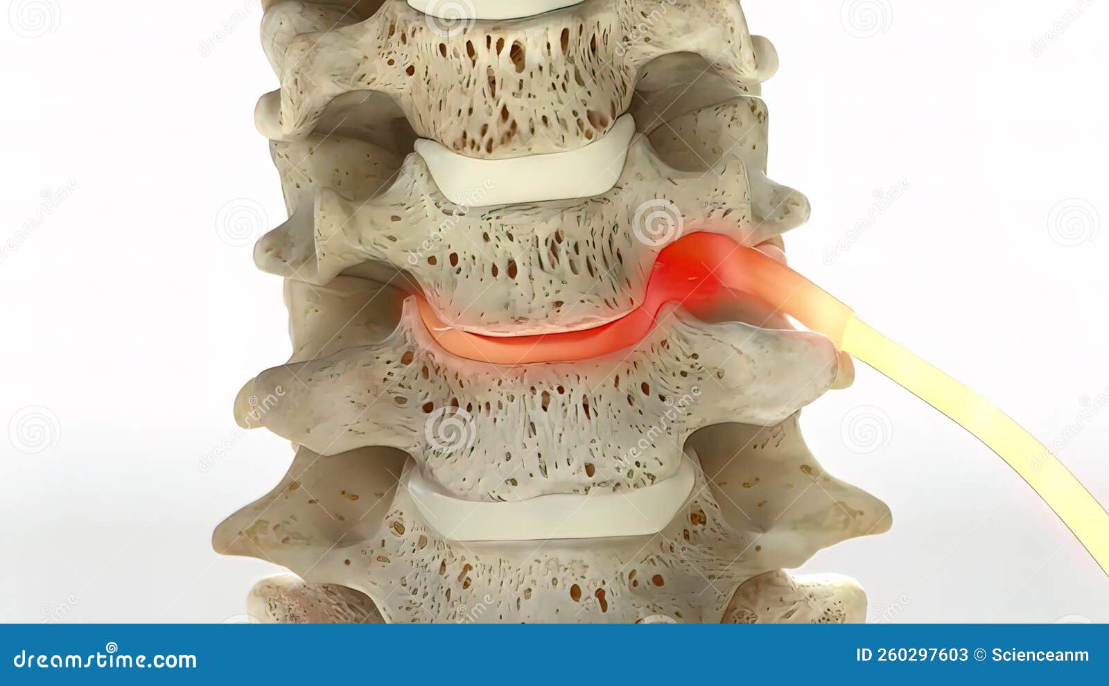 Patient Explainer for Total Disc Replacement Stock Illustration ...