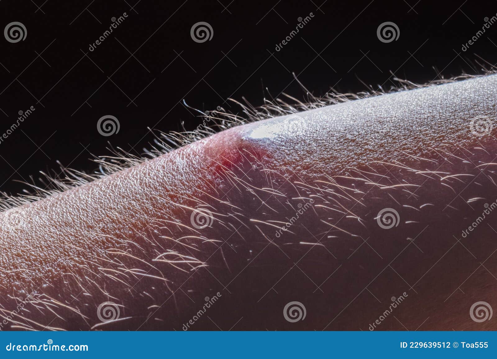 The Patient Had An Abscess On His Arm. Royalty-Free Stock Image ...