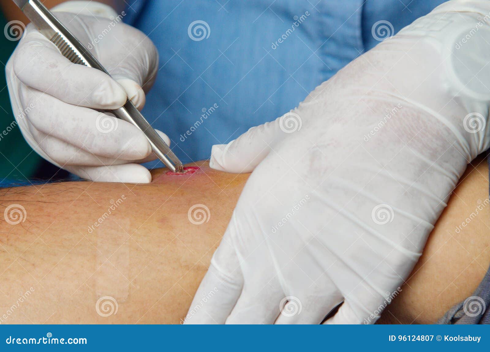 Patient had abscess. stock image. Image of patient, hands - 96124807