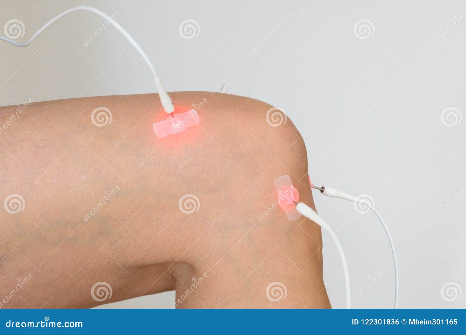 Patient Having Electrode Therapy on a Knee Joint Stock Photo - Image of ...