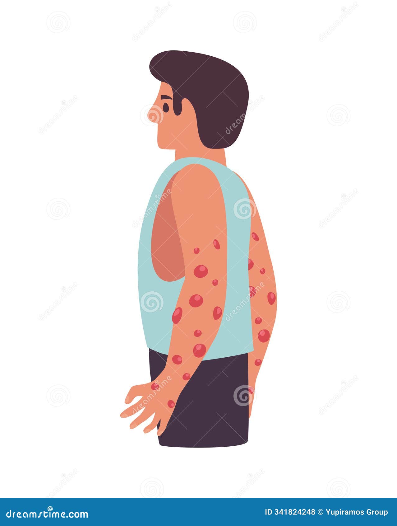 Patient with Monkey Pox Disease Stock Illustration - Illustration of ...