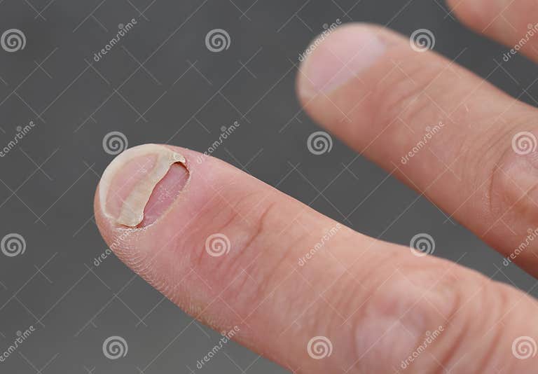 Patient with Nail Detachment Stock Image - Image of onycholysis, loose ...