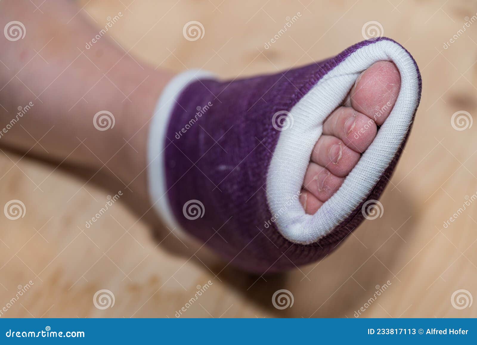Patient with a Plaster Foot - Detail Stock Image - Image of surgery ...