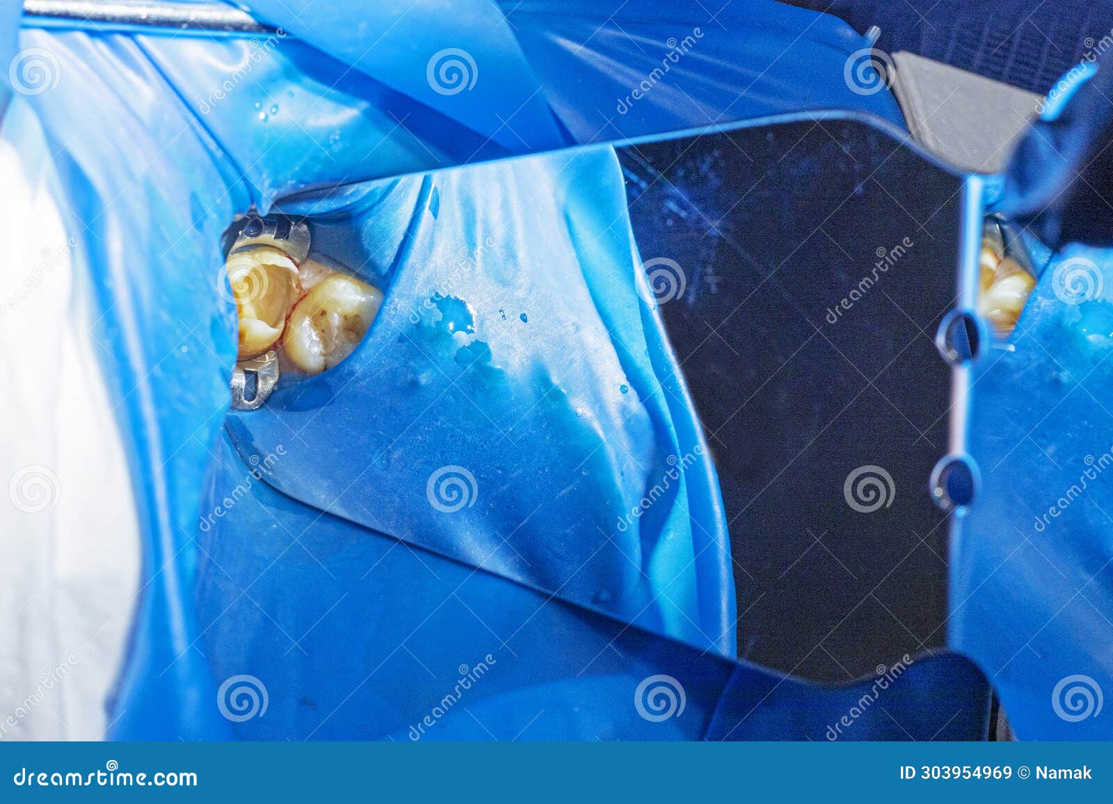 Patient S Aching Tooth with Holes before Filling Stock Image - Image of ...