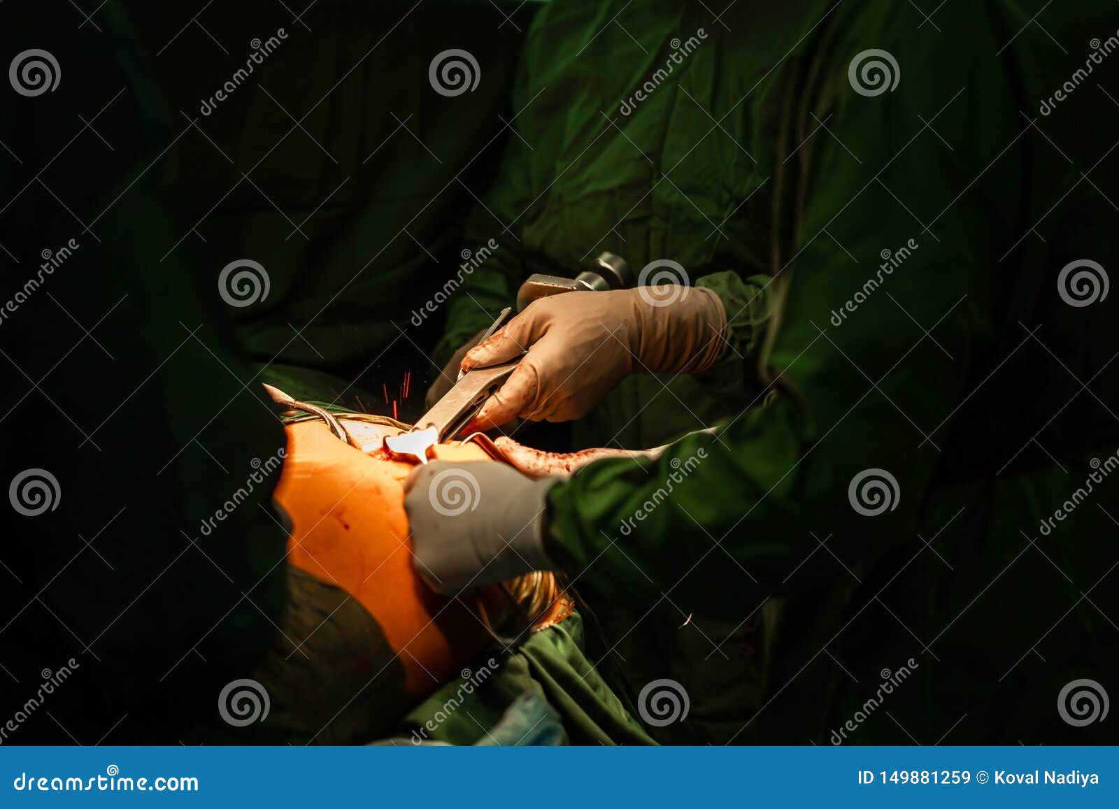 Patients and Teamwork during Hip Replacement Surgery in the Operating ...