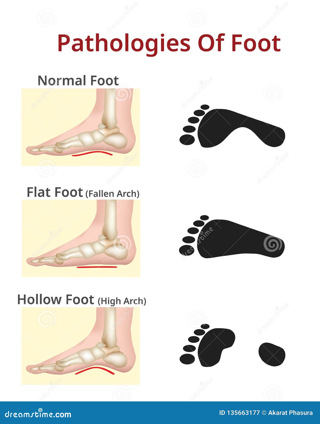 Patologías Del Pie, Pie Normal, Plano Y De Hueco - Ejemplo Del Vector ...