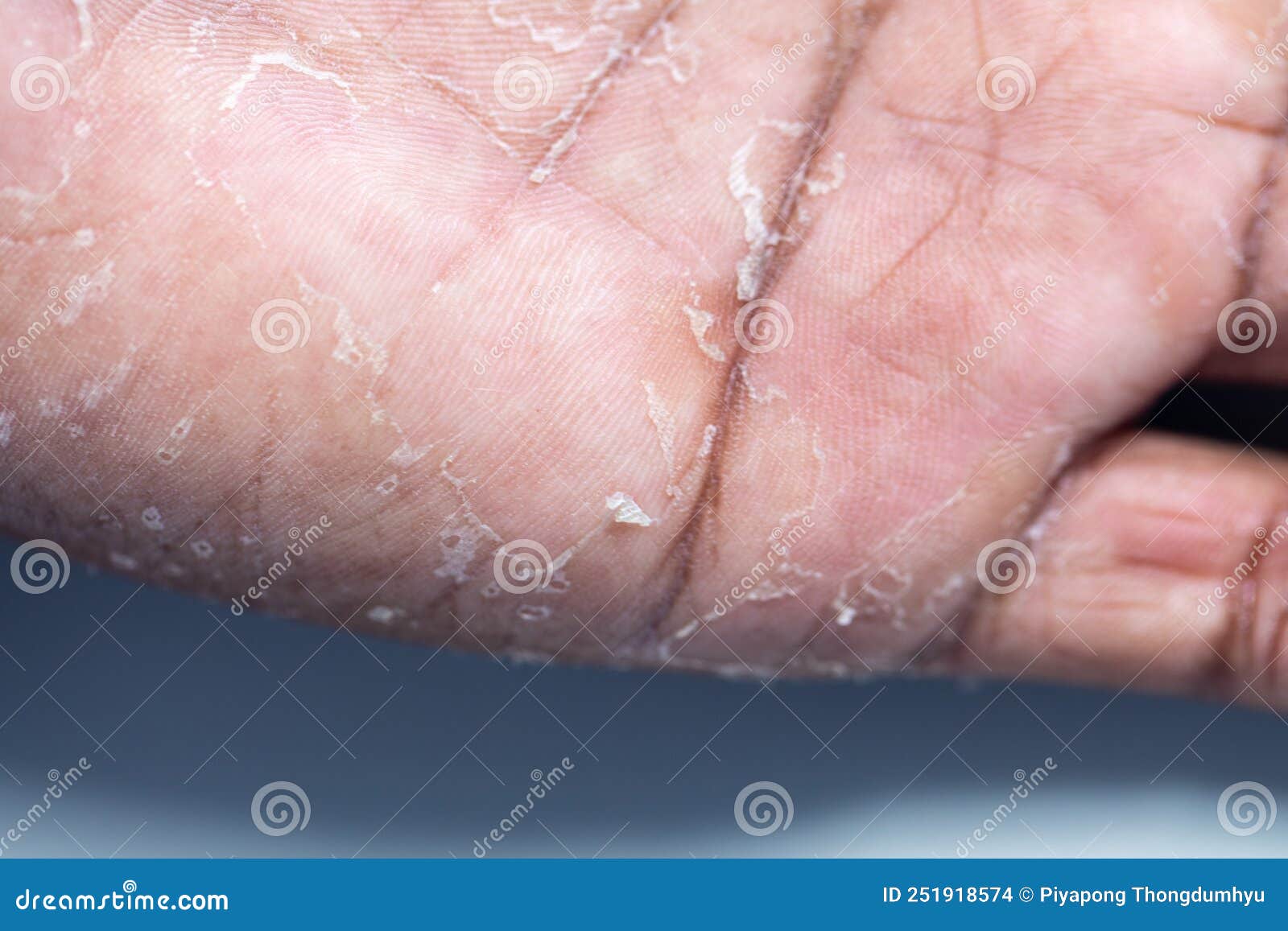 Atopic Eczema And Fungal Diseases On The Human Body. Stock Photo ...