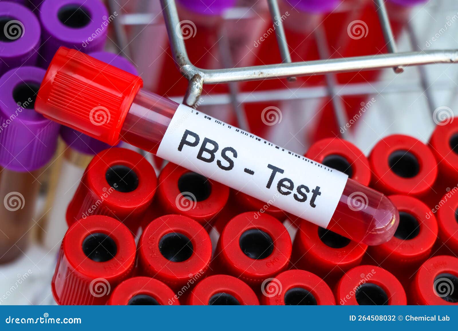PBS Test To Look for Abnormalities from Blood Stock Photo - Image of ...