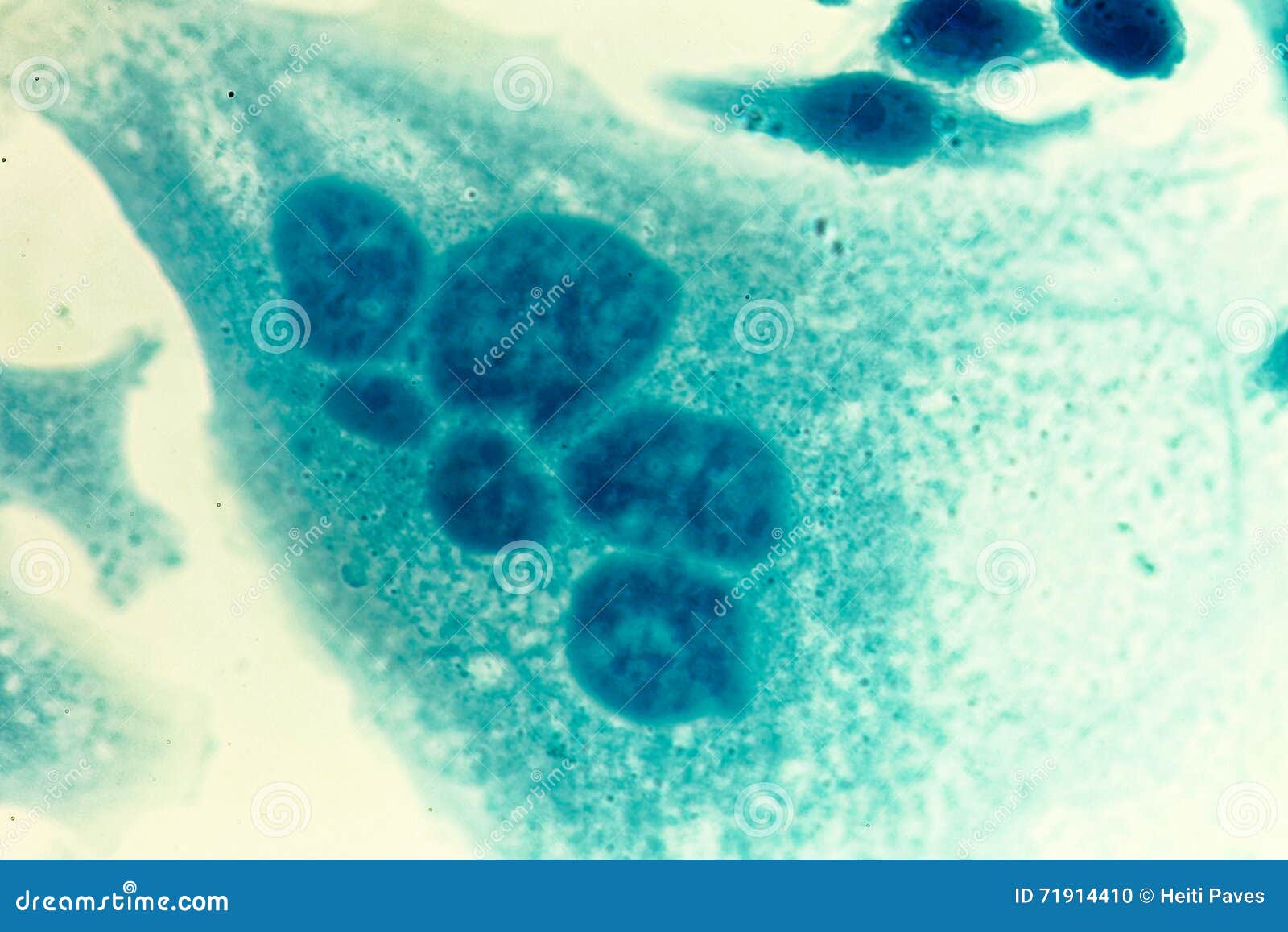 PC-3 Human Prostate Cancer Cells Stock Photo - Image of membrane ...