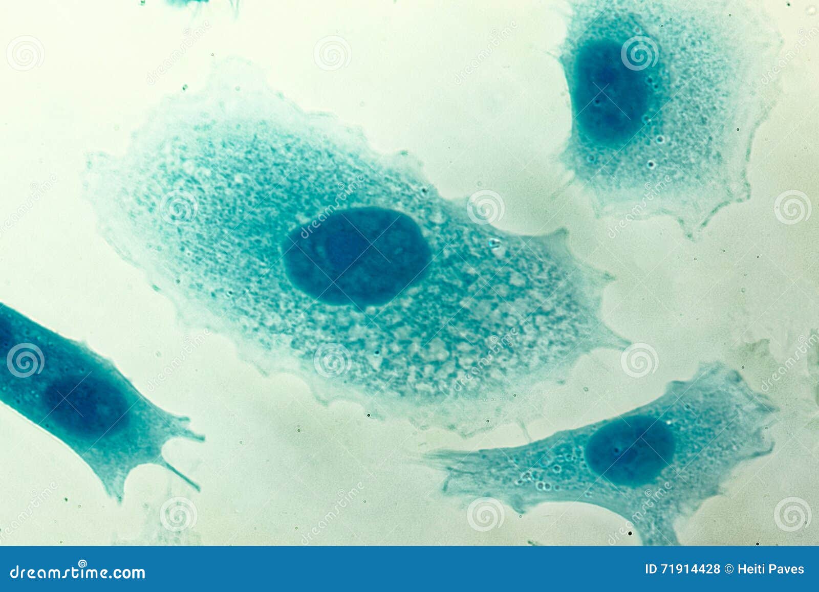 PC-3 Human Prostate Cancer Cells Stock Photo - Image of health ...