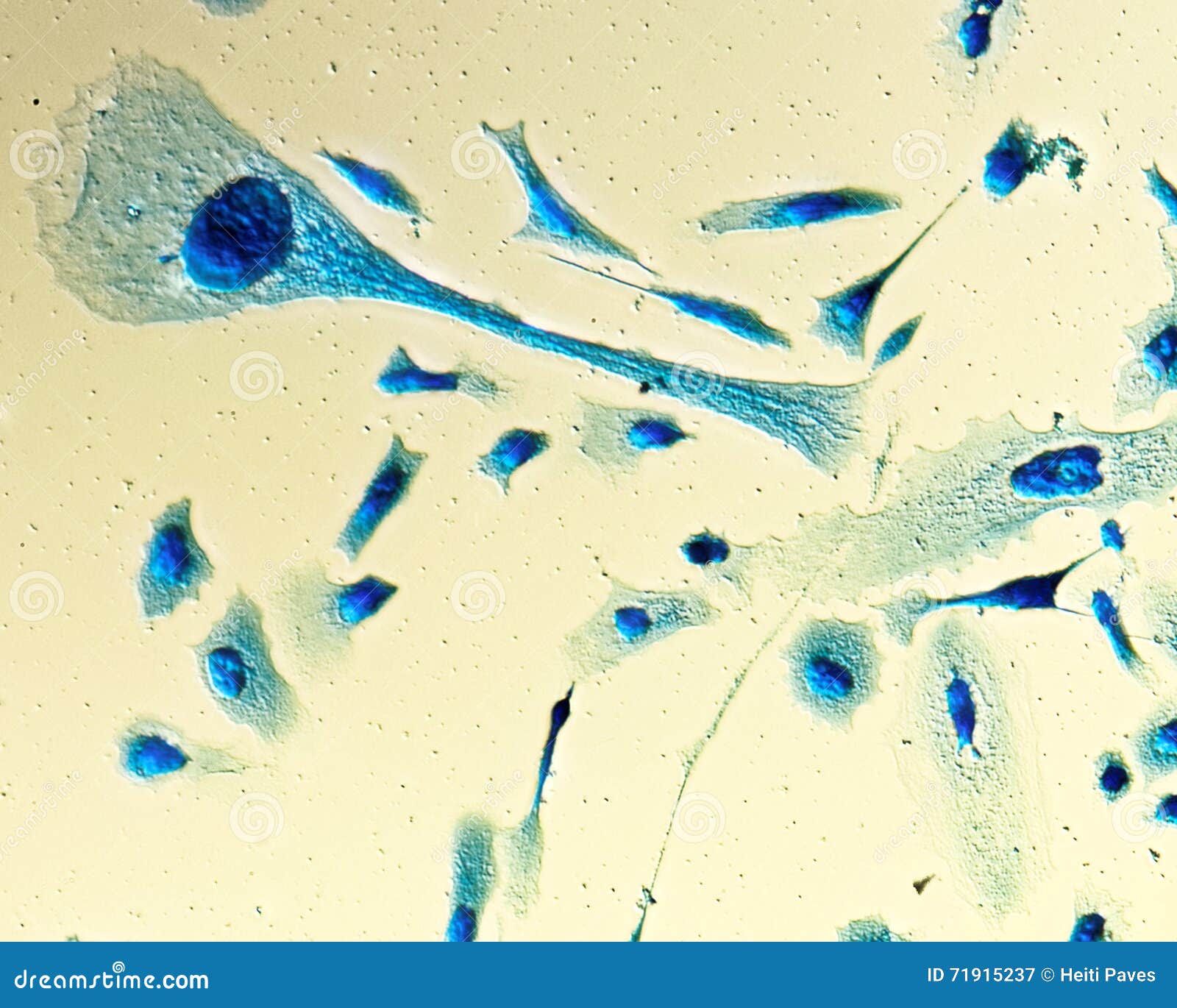 Cancer Cells Under A Microscope. Tissues Affected By Cancer Cells Under ...