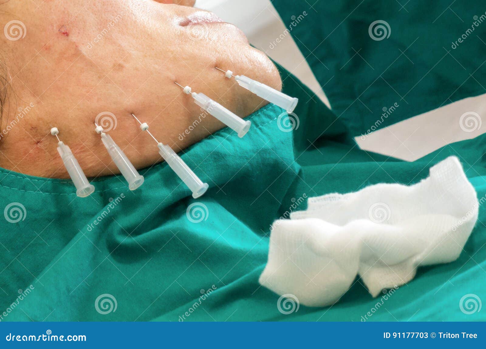 PDO Thread ,thread Lift Lifting Aesthetic Beauty Anti-aging Stock Image ...