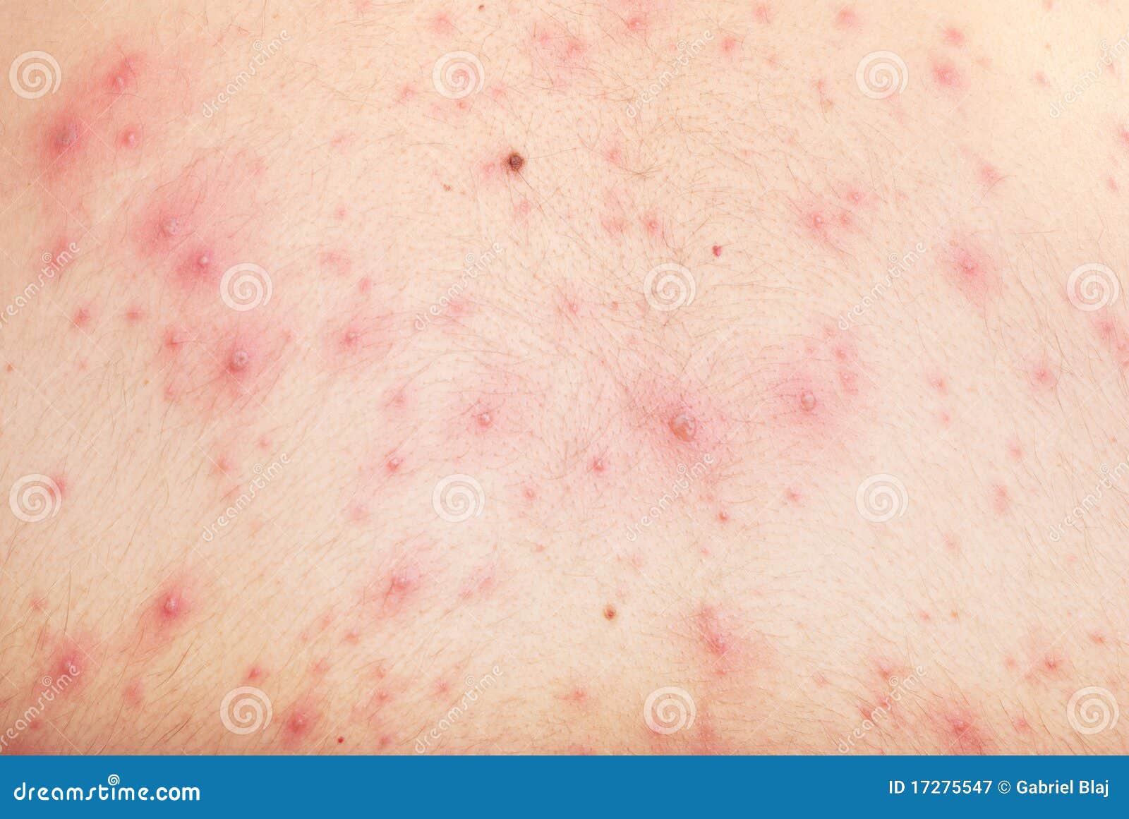 Peau avec la varicelle image stock. Image du malade, dermatologie ...
