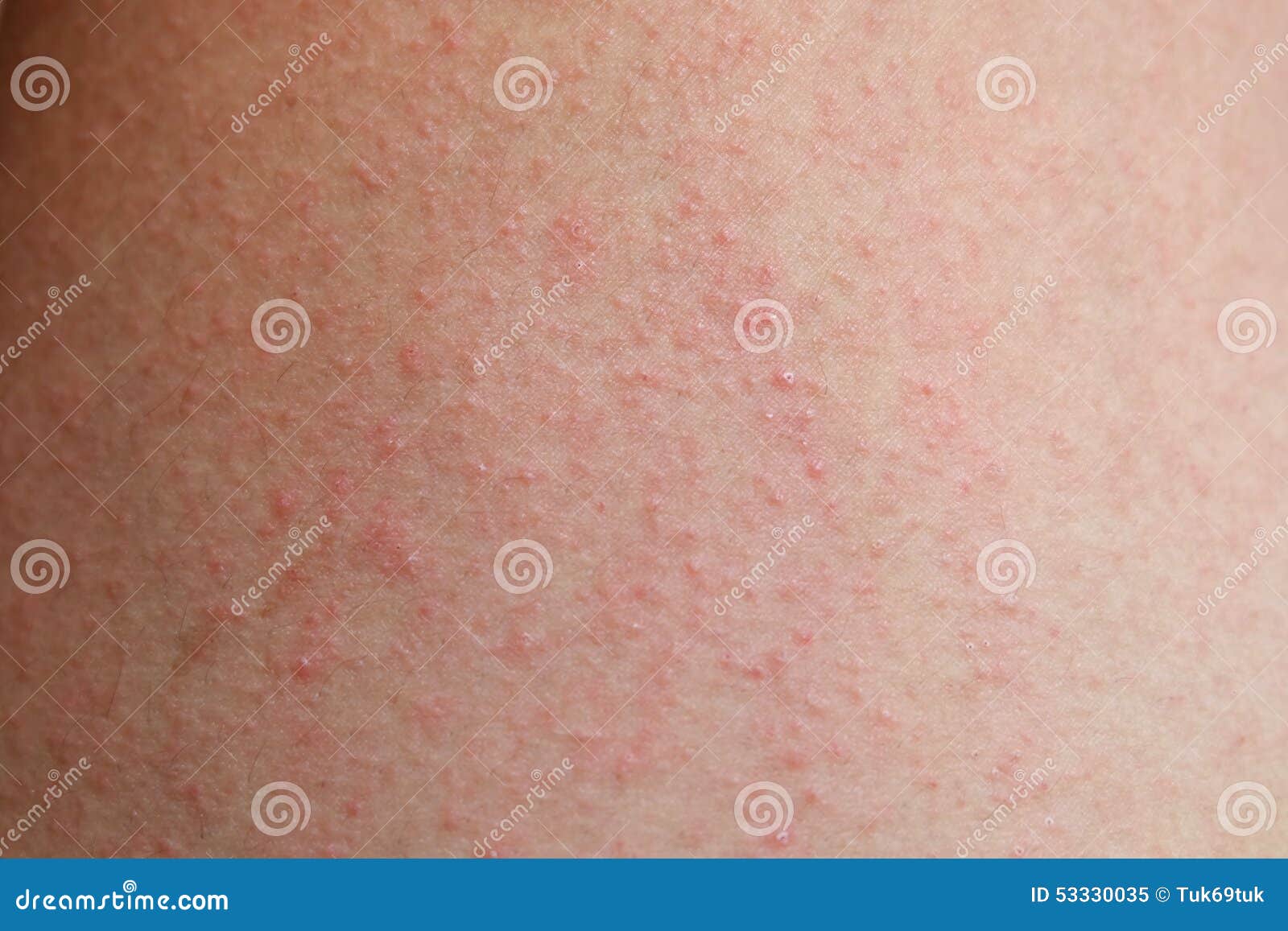 Peau Impétueuse Allergique De Dermatite Image stock - Image du ...