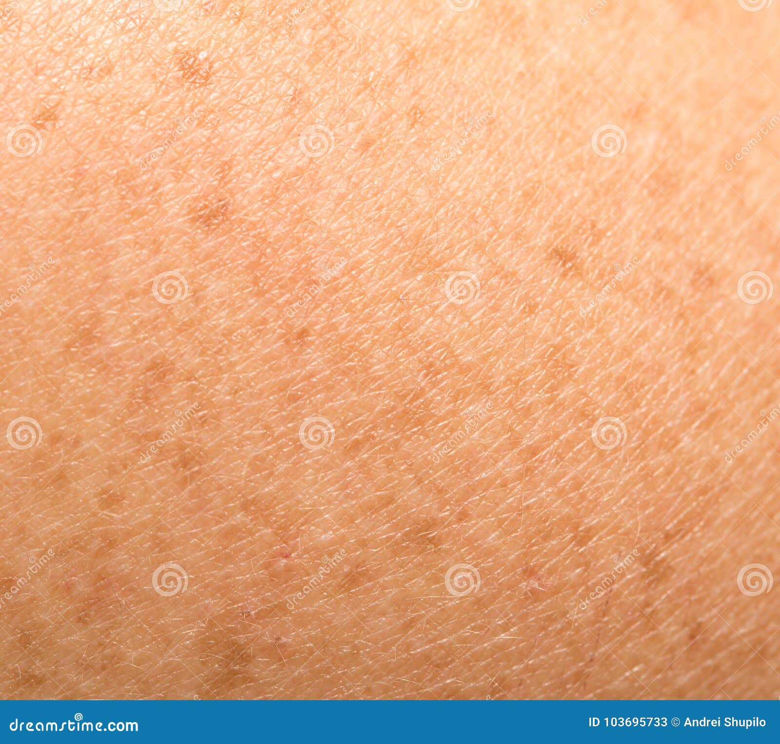 Pecas en piel humana imagen de archivo. Imagen de temerario - 103695733