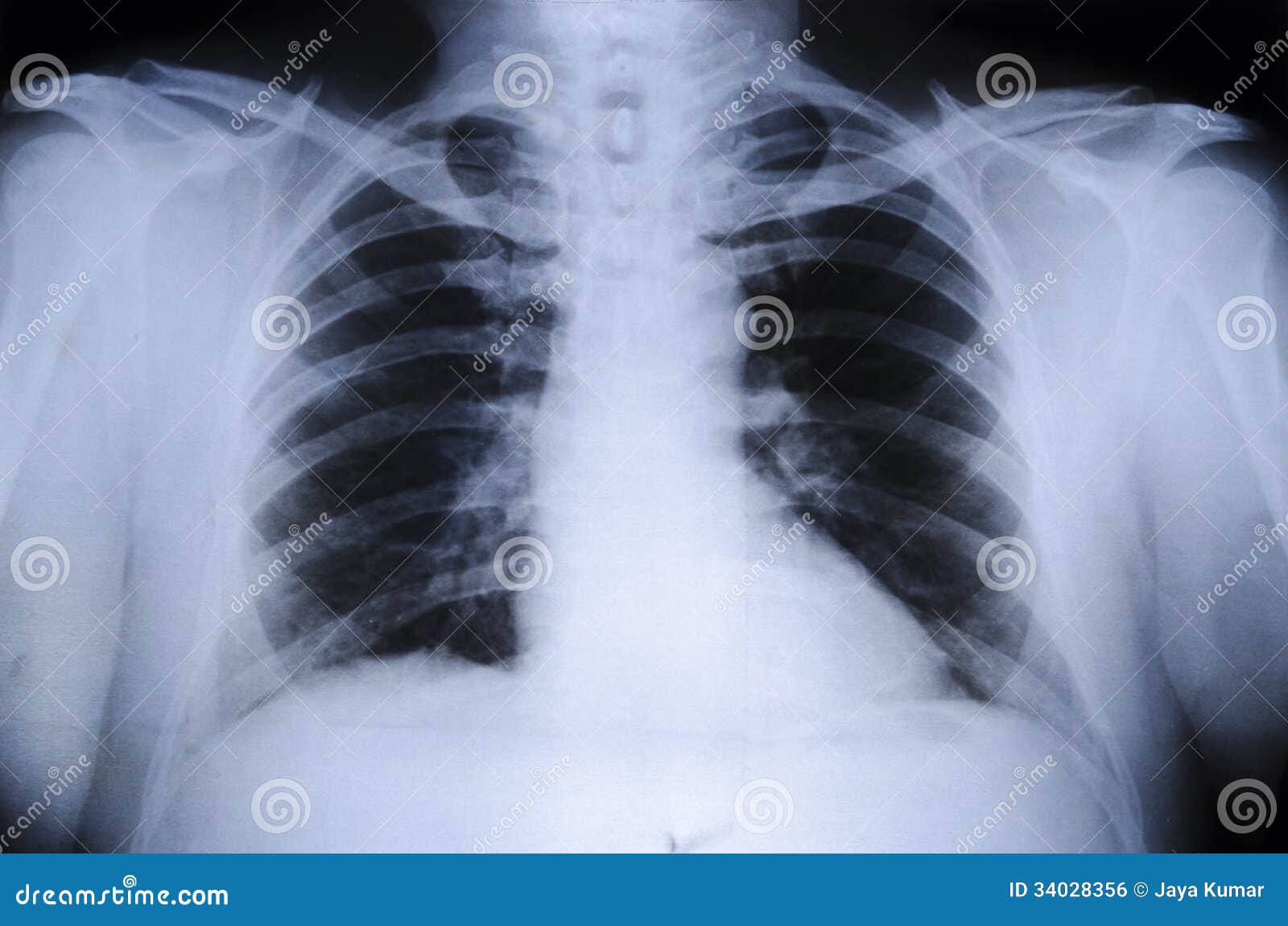 Pecho Del Ser Humano De La Radiografía Foto de archivo - Imagen de ...