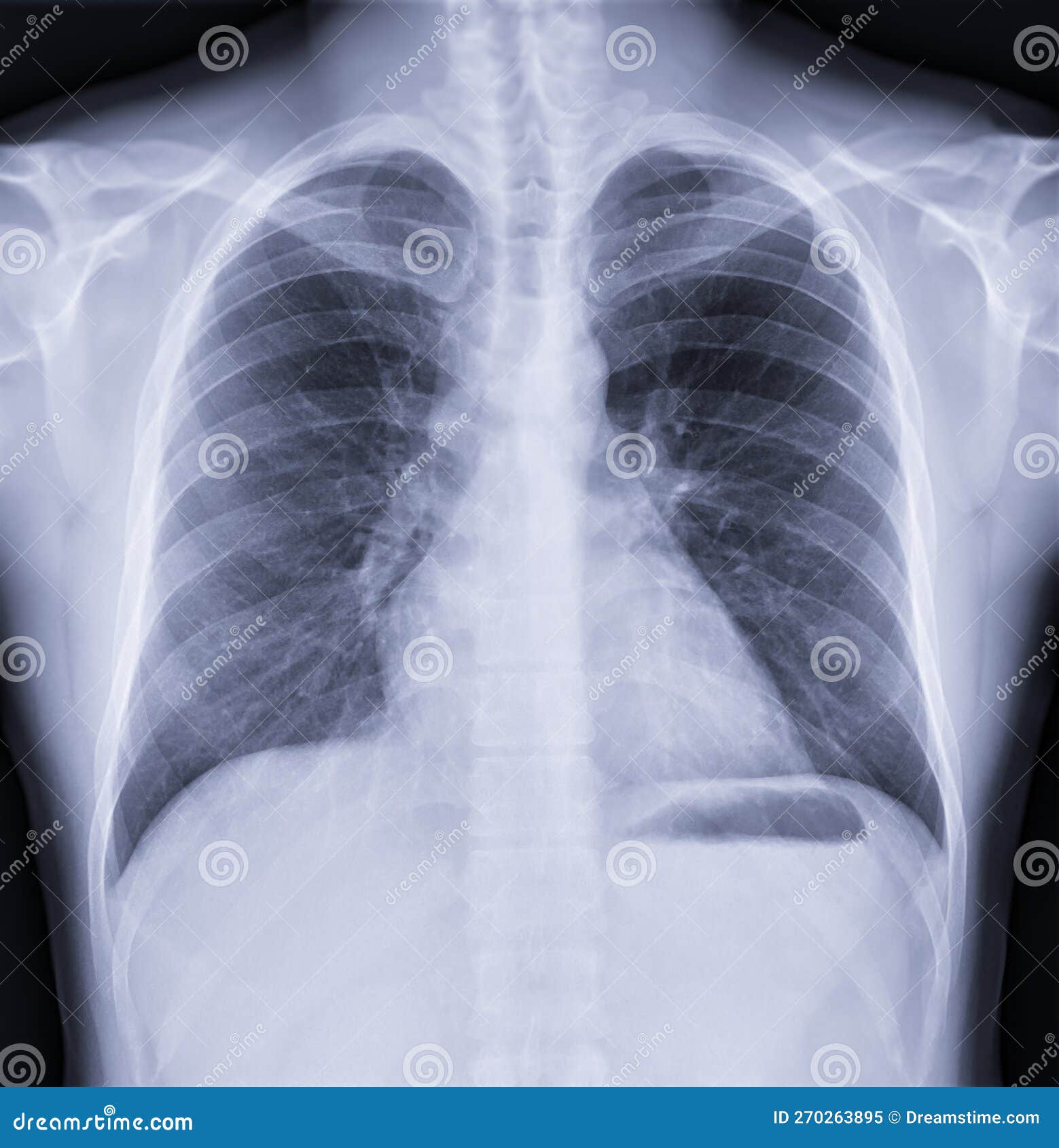 Pecho Normal De Imagen De Exudado De Pecho Imagen de archivo - Imagen ...