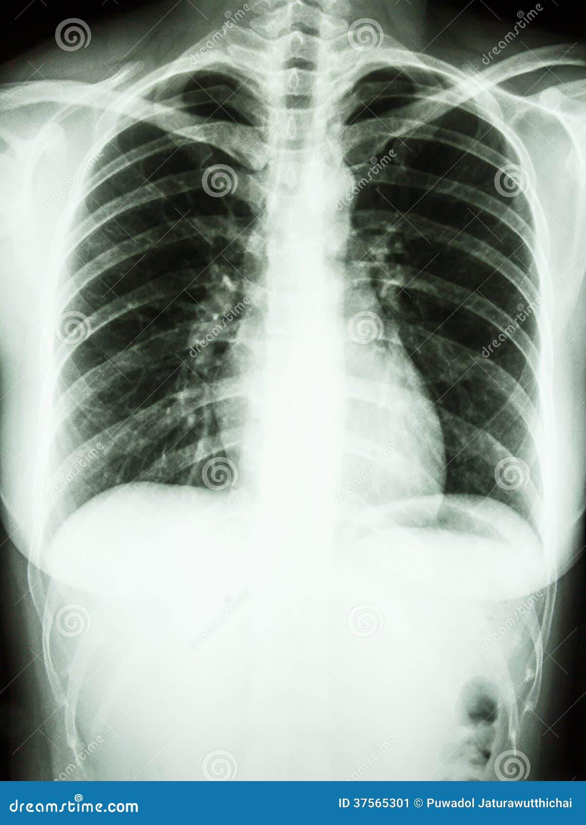 Pecho normal del human imagen de archivo. Imagen de rayo - 37565301