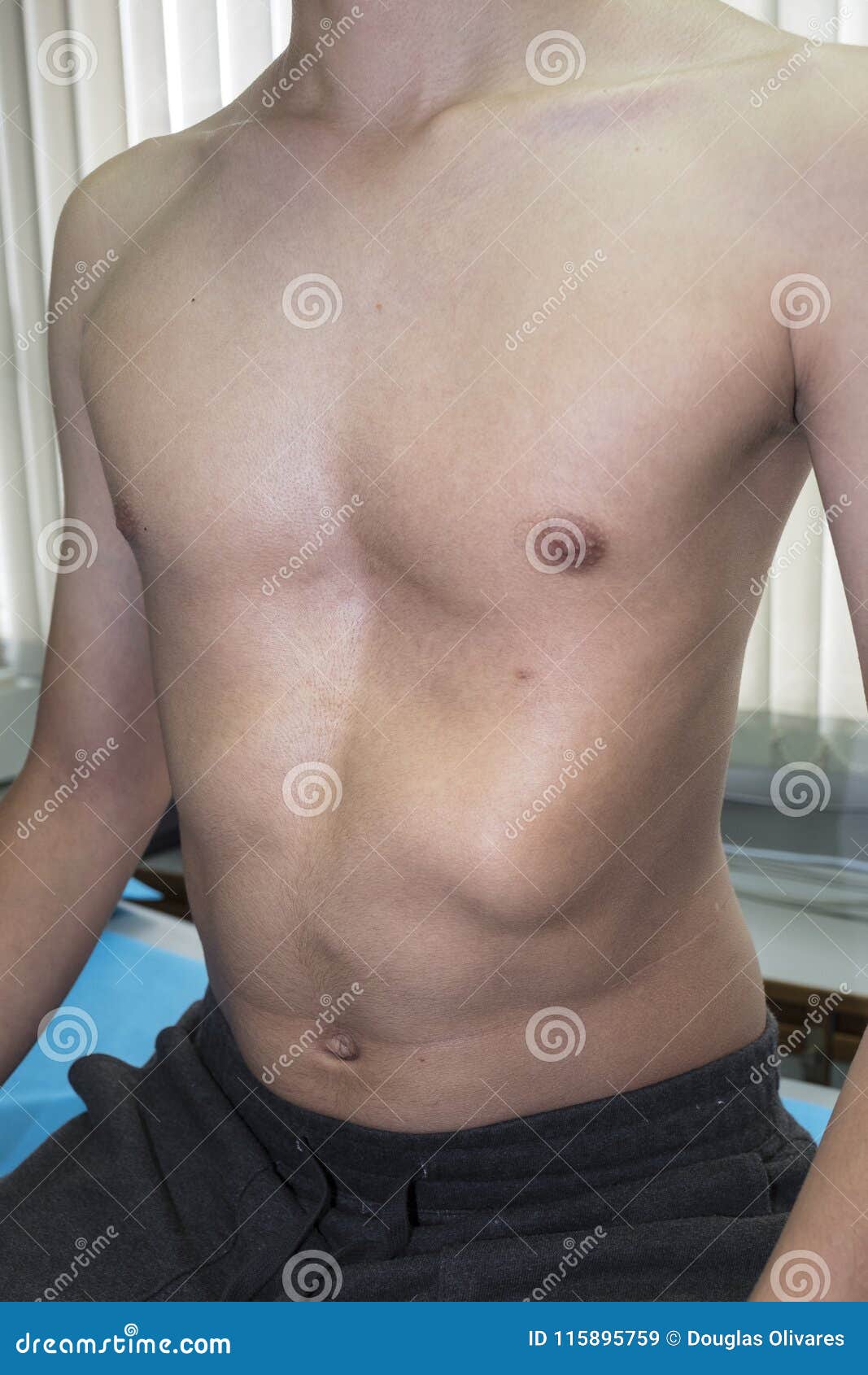 Pectus Excavatum - Pecho Hundido Imagen de archivo - Imagen de adulto ...