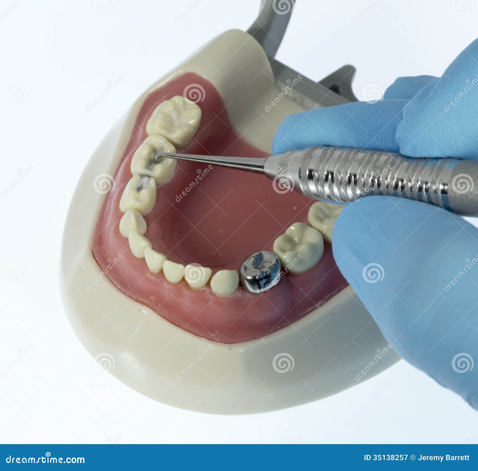 Pediatric dental filling stock image. Image of pediatric - 35138257
