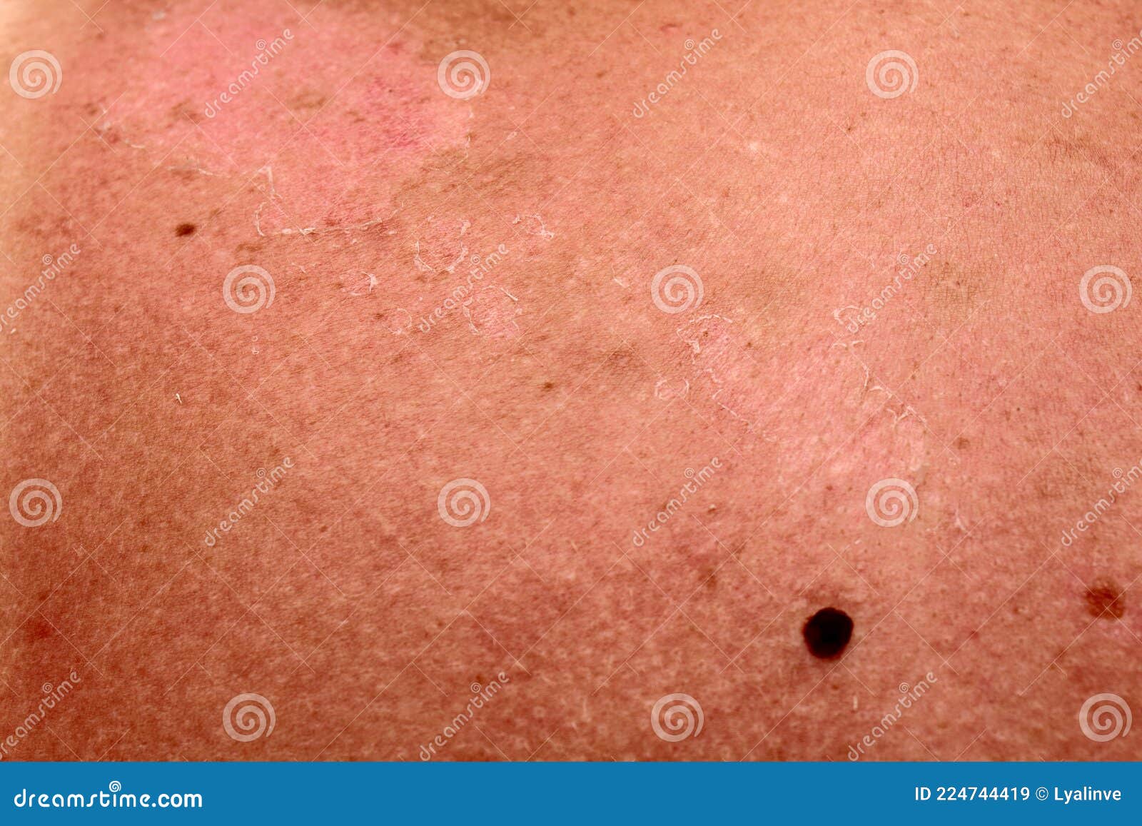Sunburned Woman Sunburn Marks On The Body Heart Shaped Sunscreen On