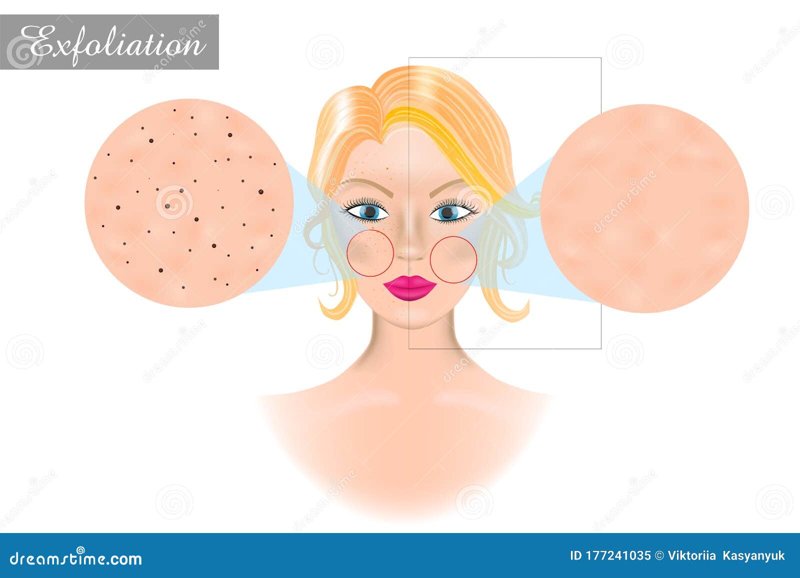Exfoliation Or Peel Is Cosmetic Procedures Cartoon Vector ...