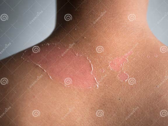 Peeling Skin At Back And Shoulder From Sunburn Effect On Body Stock