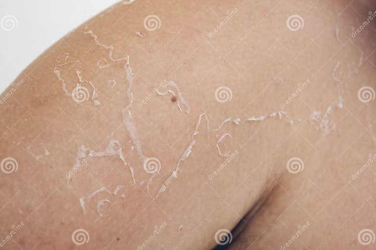 Peeling Skin At Back And Shoulder From Sunburn Effect On Body Of Young