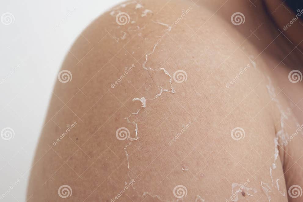 Peeling Skin At Back And Shoulder From Sunburn Effect On Body Of Young