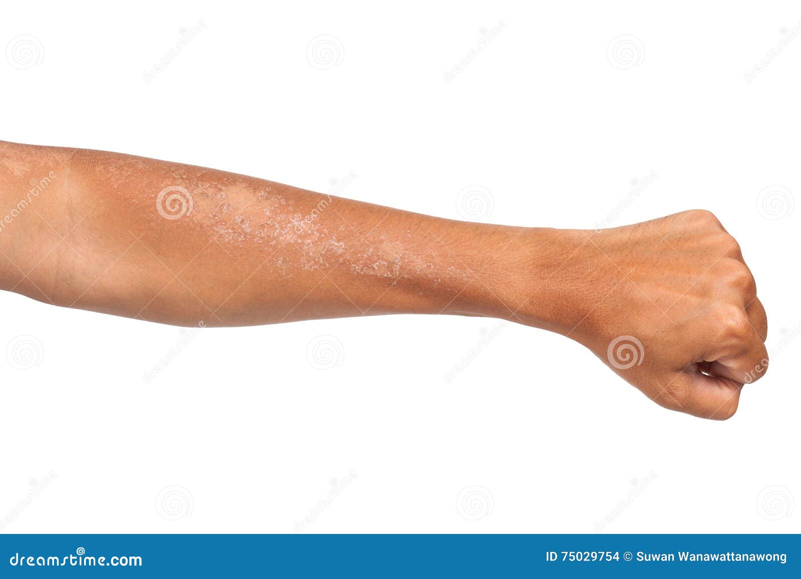 Peeling of Skin after Burned by Sunlight Stock Photo - Image of painful ...