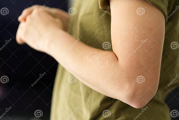 Peeling Skin At Shoulder From Sunburn Effect On Body Of Young Woman