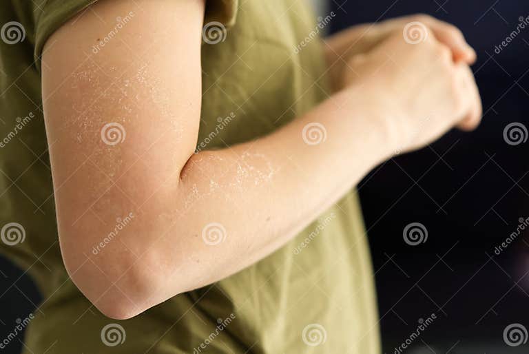 Peeling Skin At Shoulder From Sunburn Effect On Body Of Young Woman