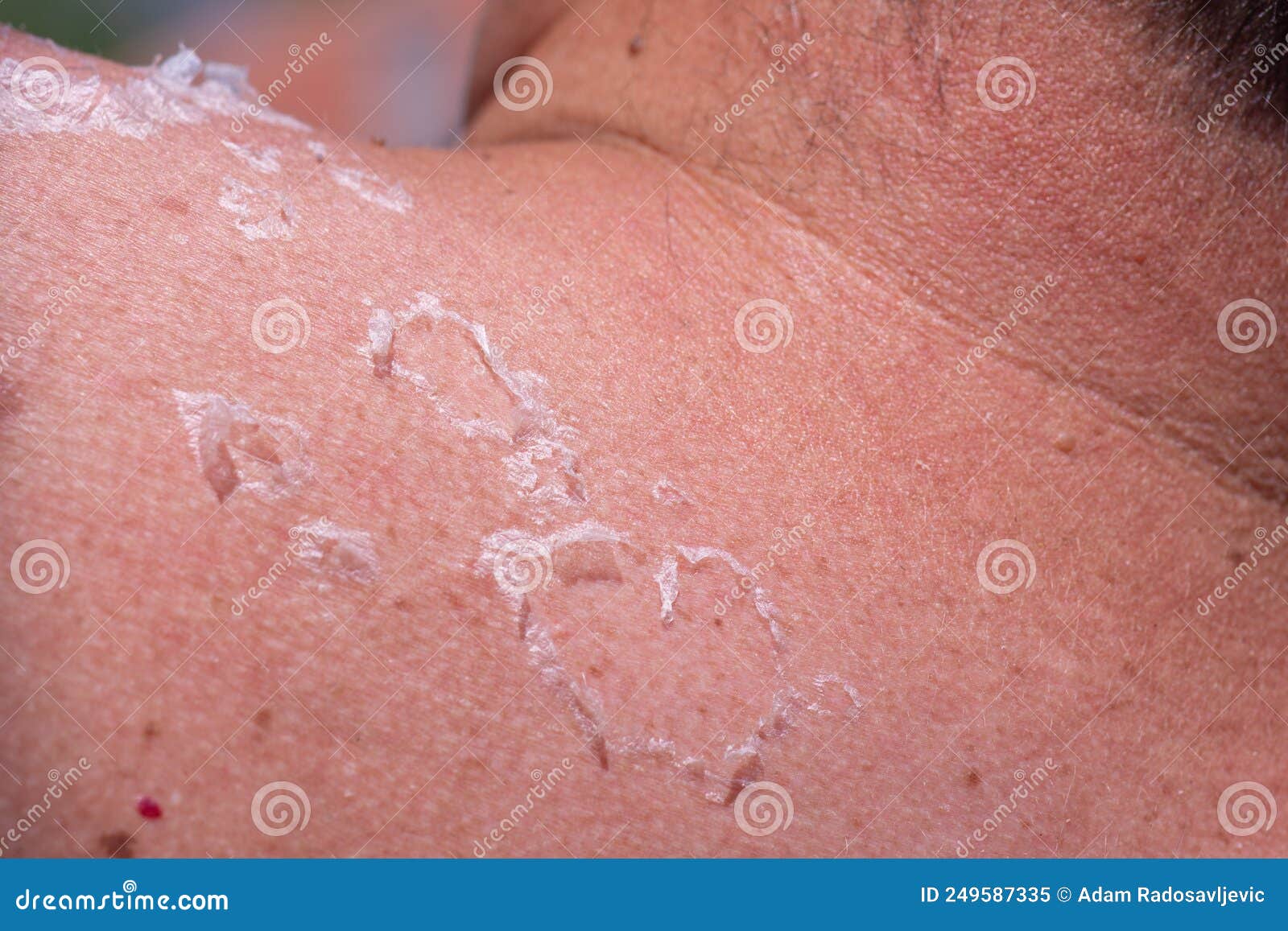 Peeling Sunburned Skin On Back And Shoulder Stock Image Image Of
