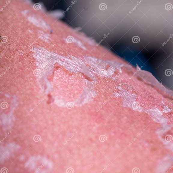 Peeling Sunburned Skin On Back And Shoulder Stock Image Image Of