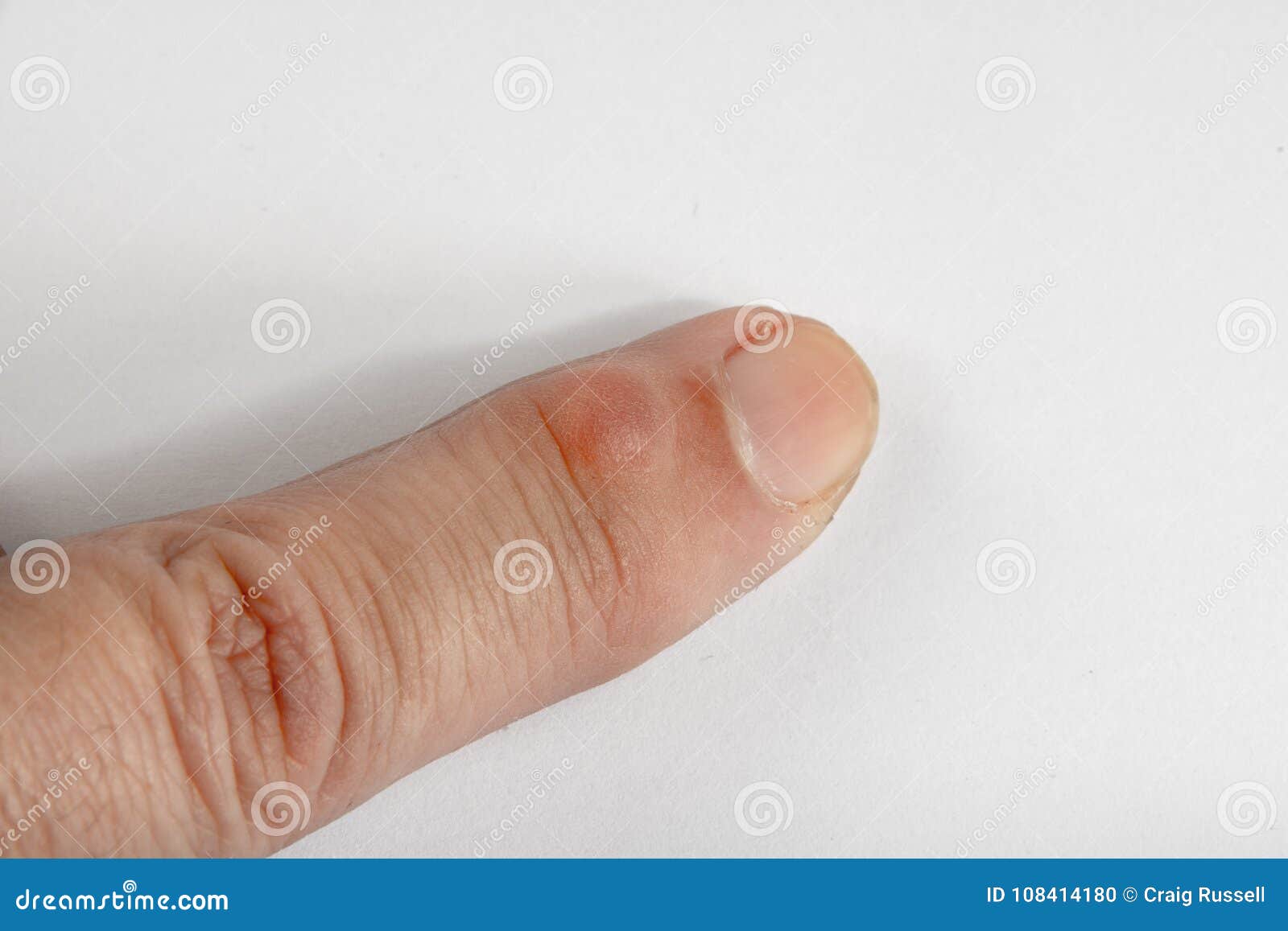 Peesknoopcyste op vinger stock foto. Image of cyste - 108414180