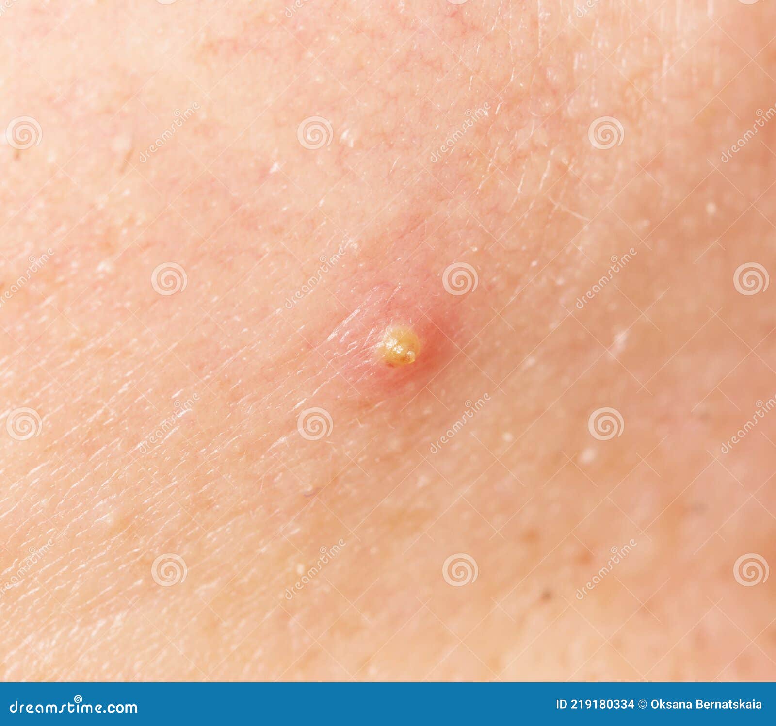 Pele Acne Inflamada Como Pano De Fundo Foto de Stock - Imagem de cara ...