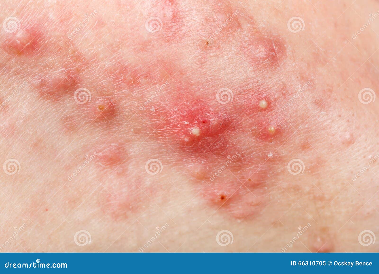 Pele Cística Nodular Da Acne Imagem de Stock - Imagem de fêmea ...