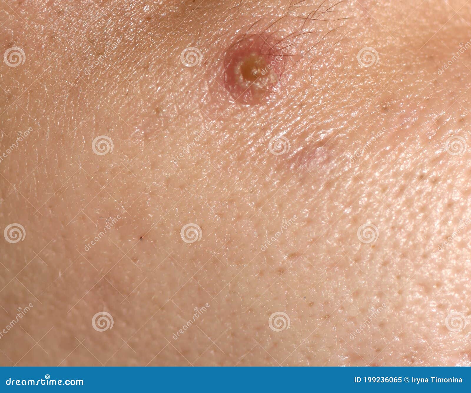 Pele Inflamada Acne Na Face Invólucro Na Pele Imagem de Stock - Imagem ...