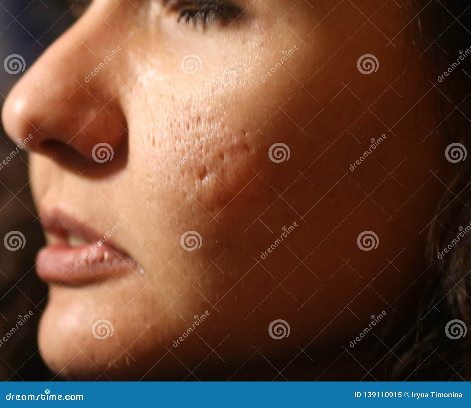 Pele Inflamada Da Cara Nas Espinhas E Na Acne O Keloid Scars Da Acne ...