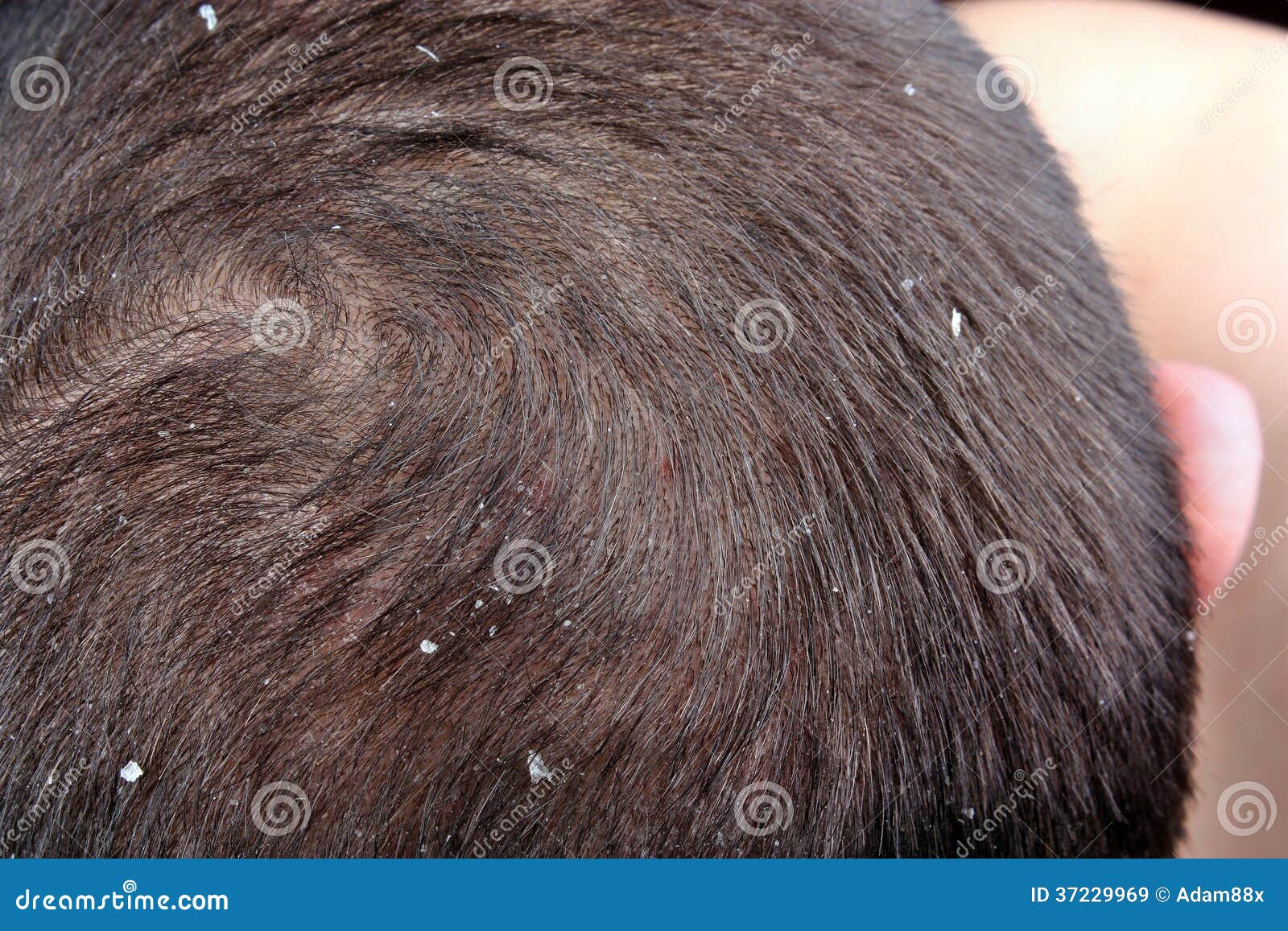 Pellicules Dans Les Cheveux Image stock - Image du émission, noir: 37229969