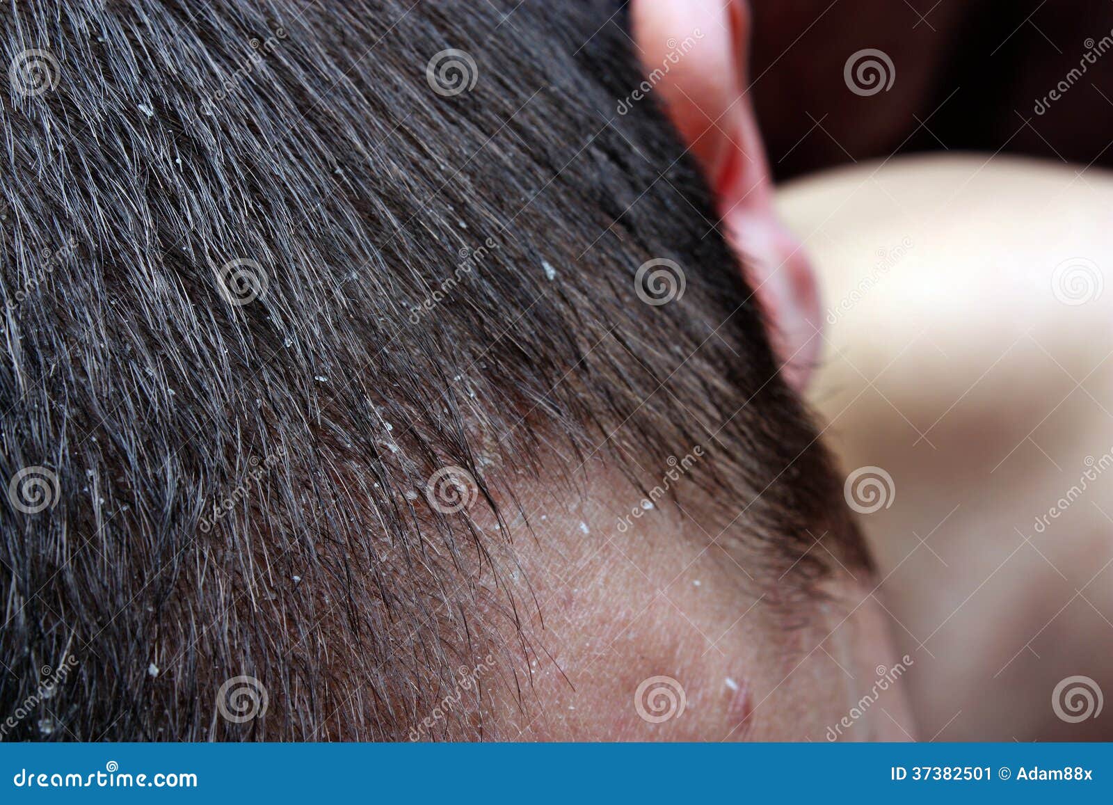 Pellicules Dans Les Cheveux Image stock - Image du médecine, soin: 37382501