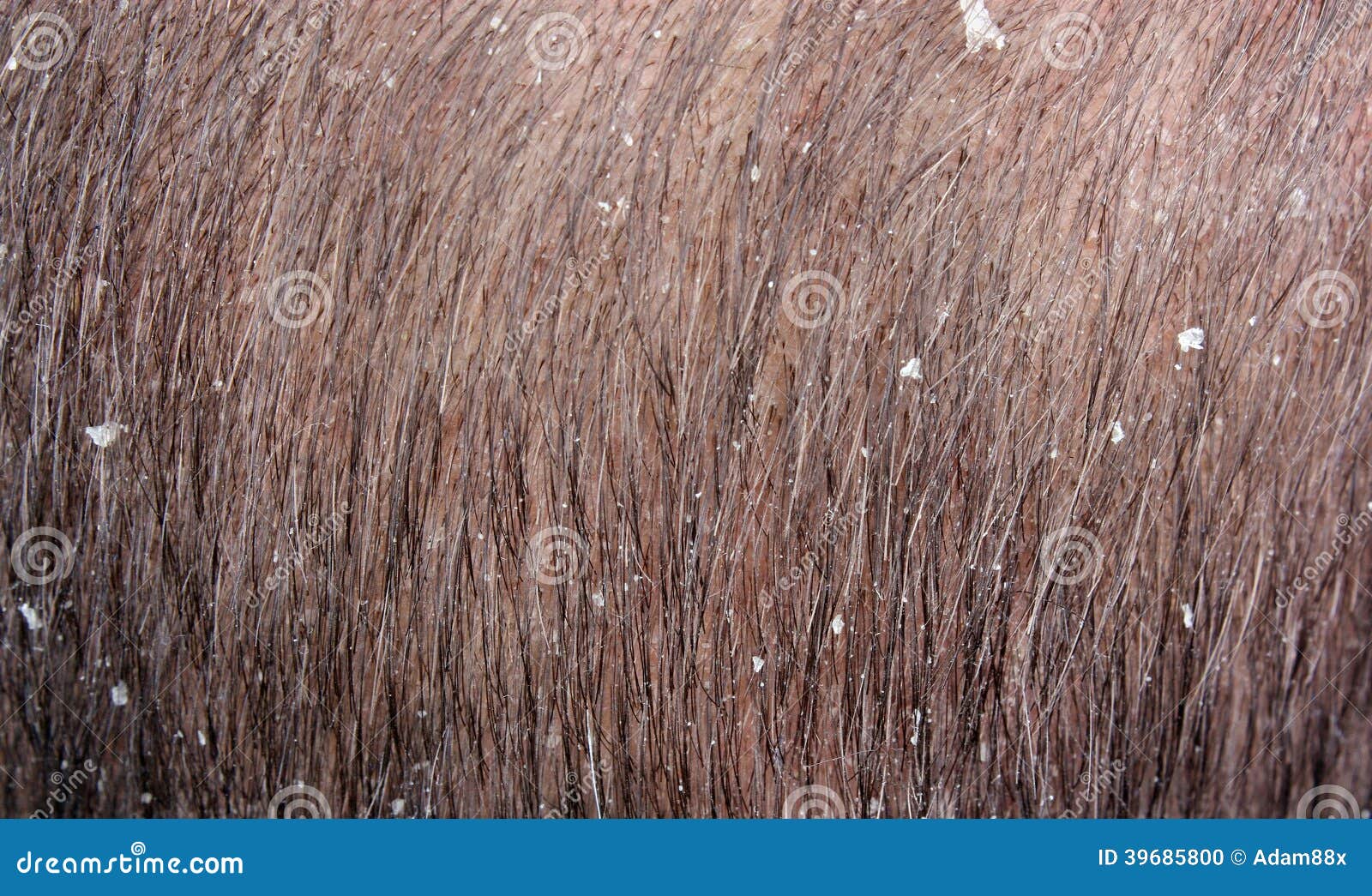 Pellicules Dans Les Cheveux Photo stock - Image du émission, sain: 39685800