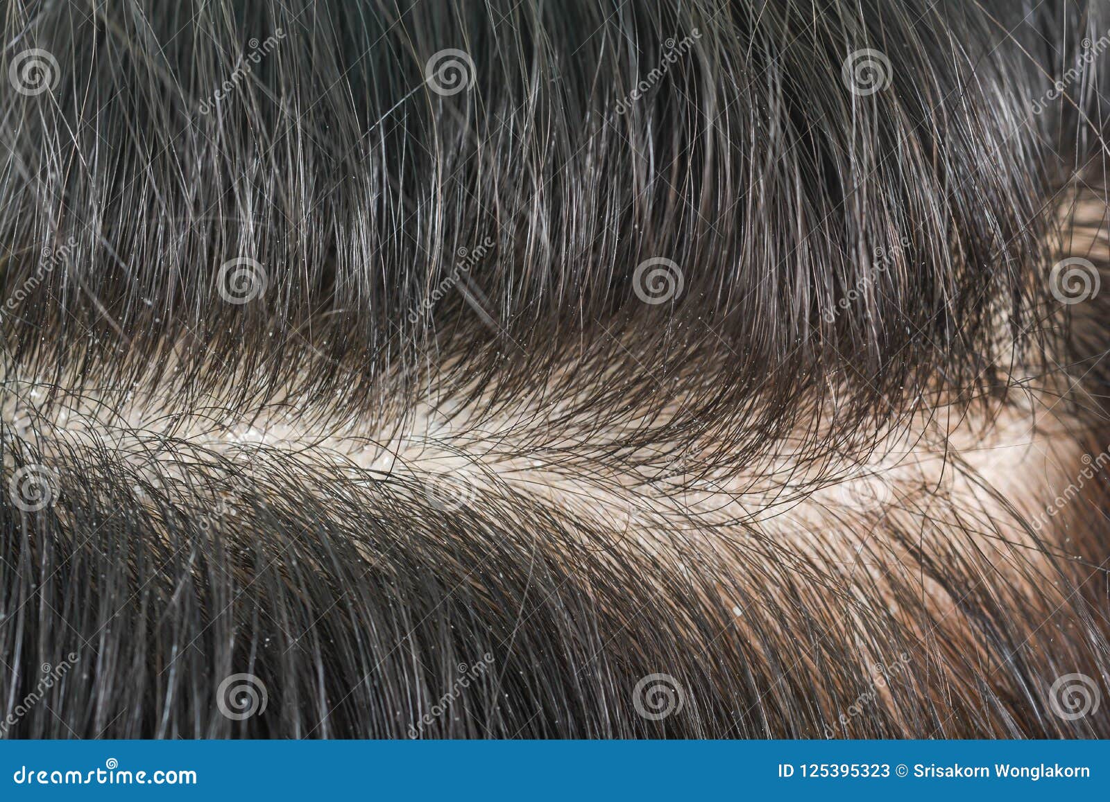Pellicules Et Cuir Chevelu De Pellicules De Cheveux Image stock - Image ...
