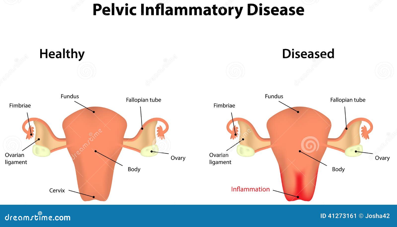 Pelvic Inflammatory Disease Vector Linear Icon Isolated On Transparent ...
