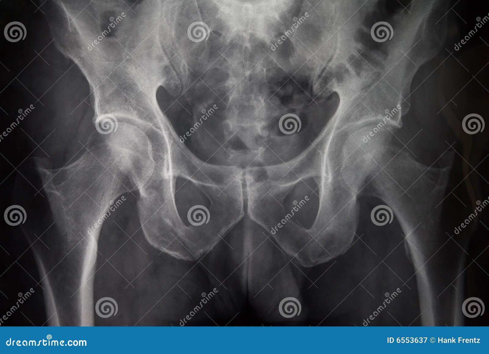 Pelvic x-ray stock image. Image of vertebra, hips, radiography - 6553637