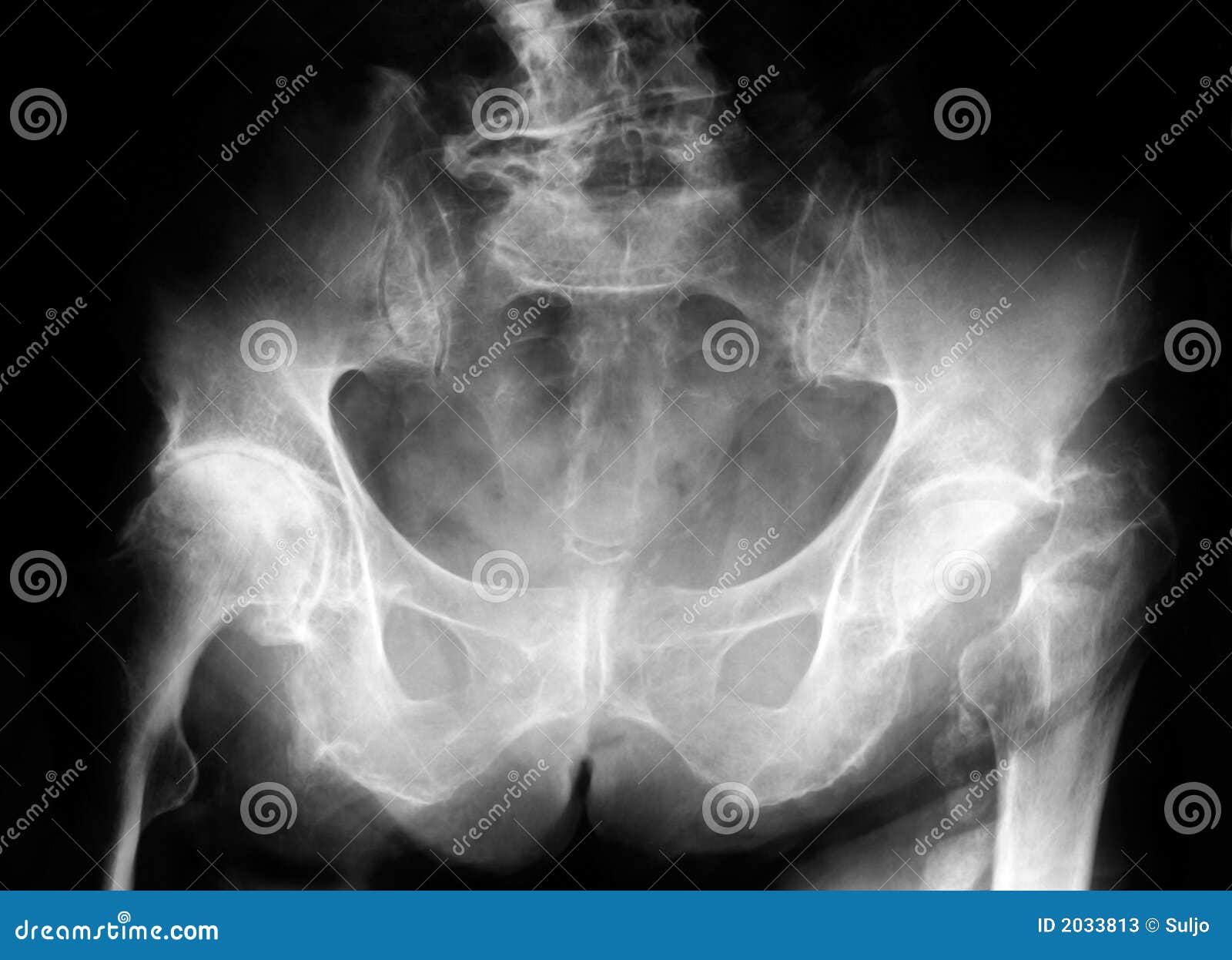 Pelvis stock image. Image of inside, abdomen, check, radiation - 2033813