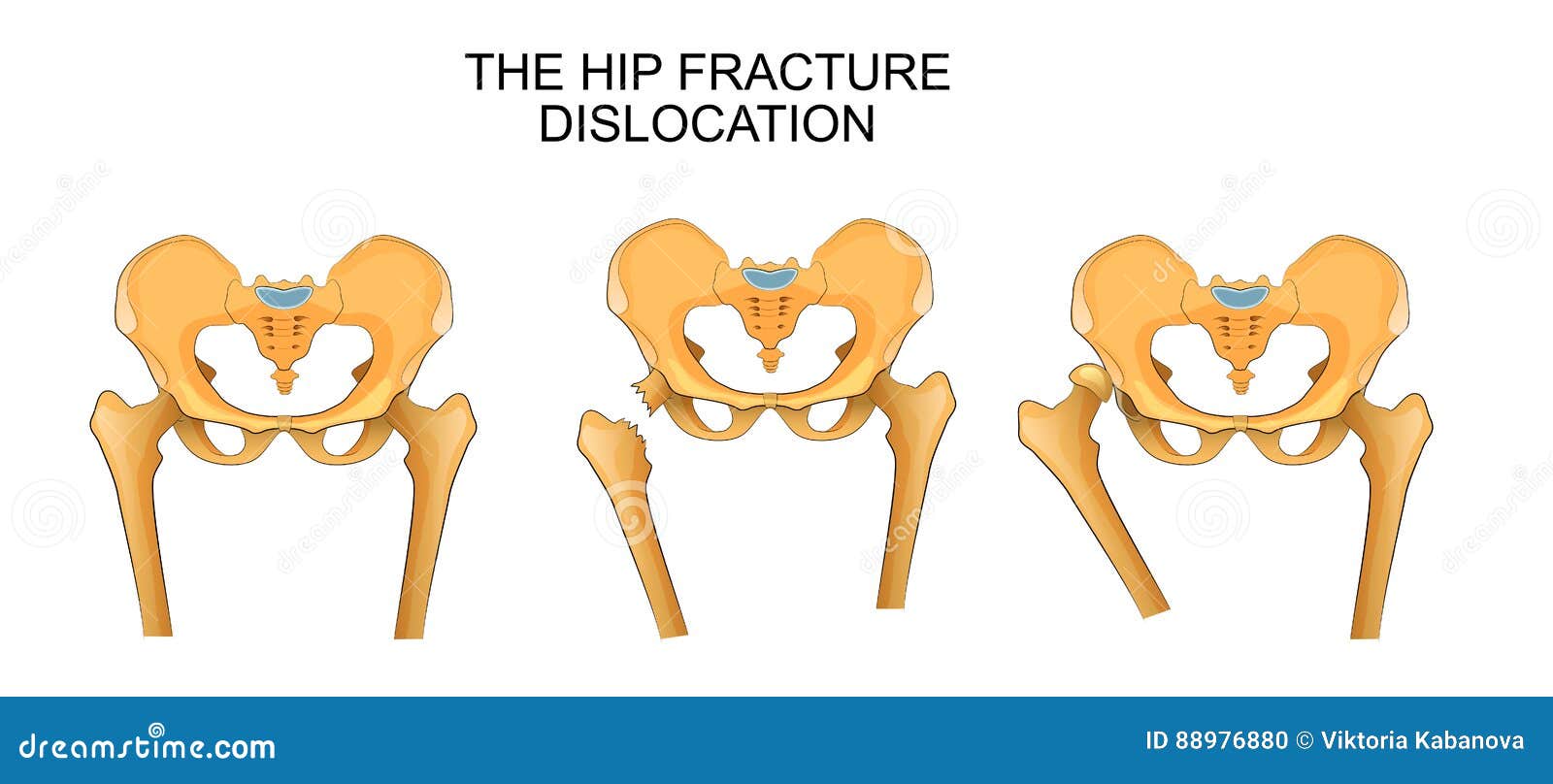 Pelvis, Hip Fracture. Hip Dislocation Vector Illustration ...