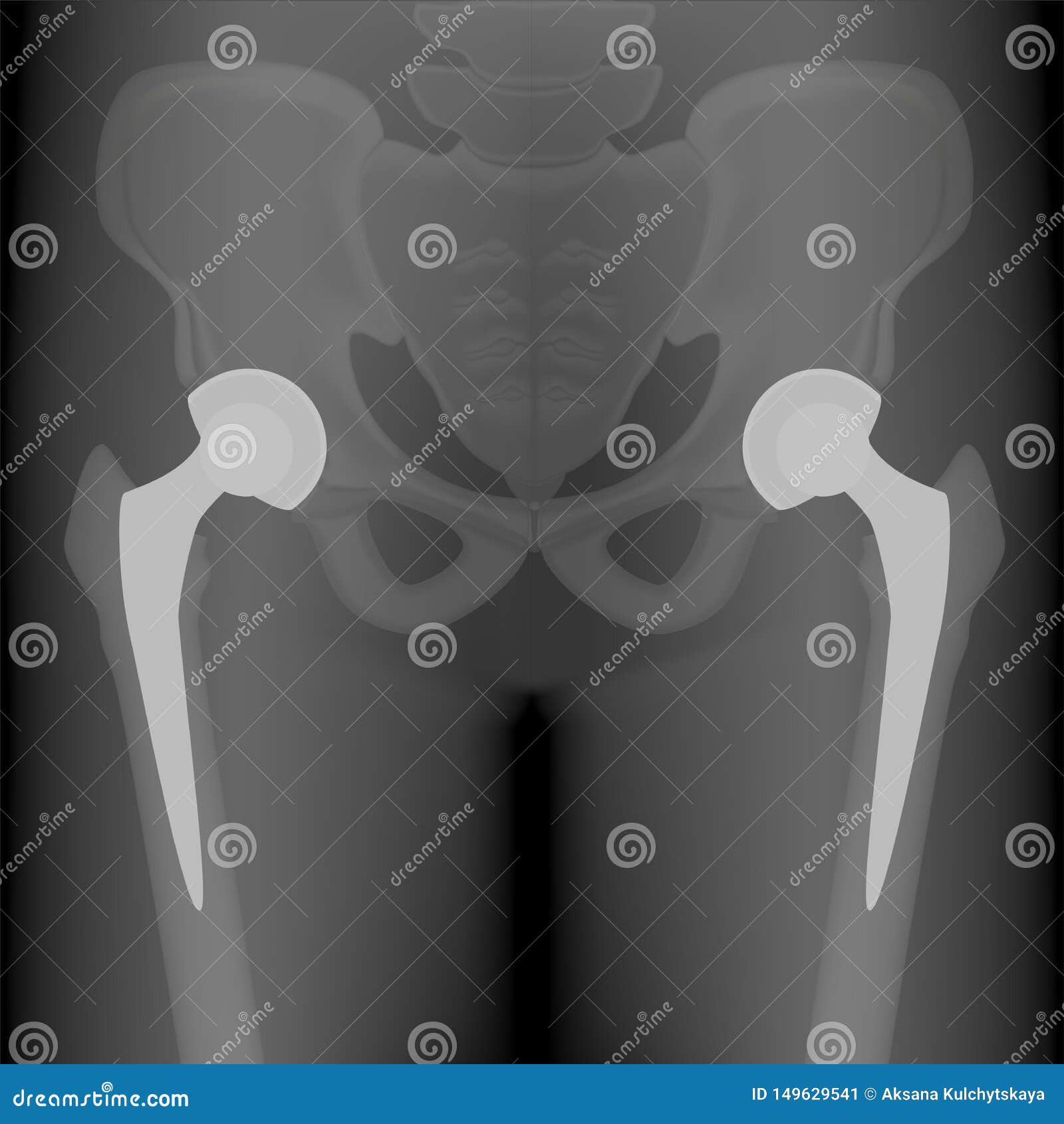 Pelvis and Hip Joint Problem_Bilateral Hip Replacement Stock Vector ...